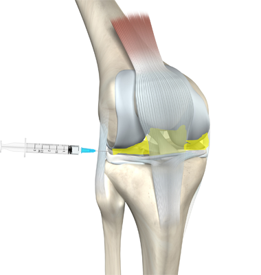 콘쥬란 주사 | 서재곤링커병원